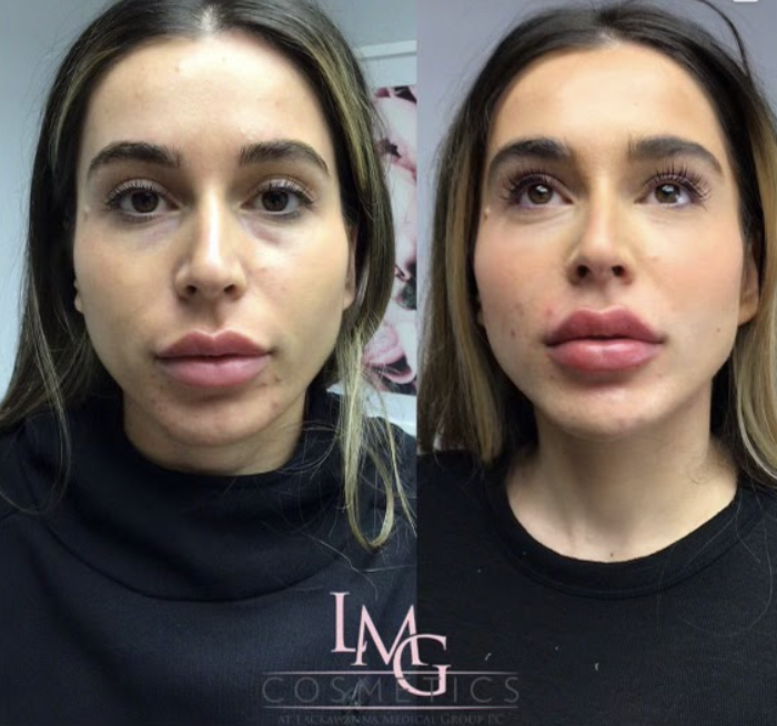 Lip Filler Injections in Scranton, PA | LMG Cosmetics