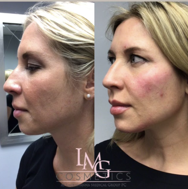 Lip Filler Injections in Scranton, PA | LMG Cosmetics